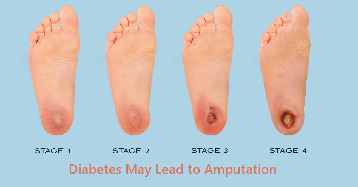 How Diabetes May Lead to Amputation