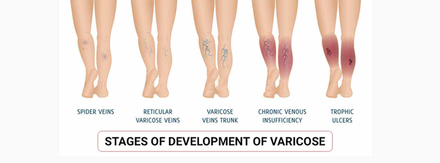 Understanding the 4 Stages of Varicose Veins
